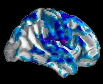 MRI & Corticobasal Degeneration (CBD)