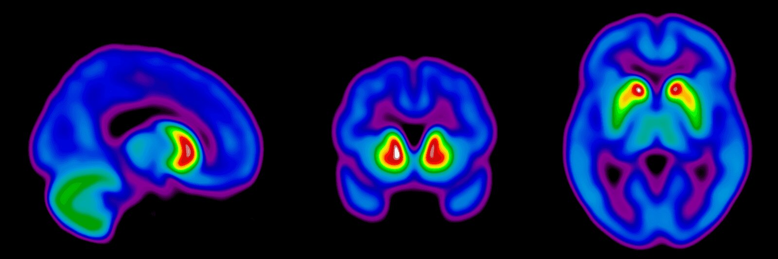 Traitement de l'image SPECT Traitement des images SPECT