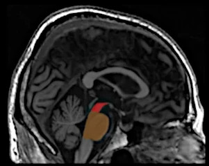 MRPI & MRPI 2.0 for PSP MRI Brain Atrophy Analysis