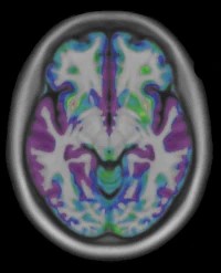 Frontotemporal Dementia (FTD) & MRI Brain Atrophy